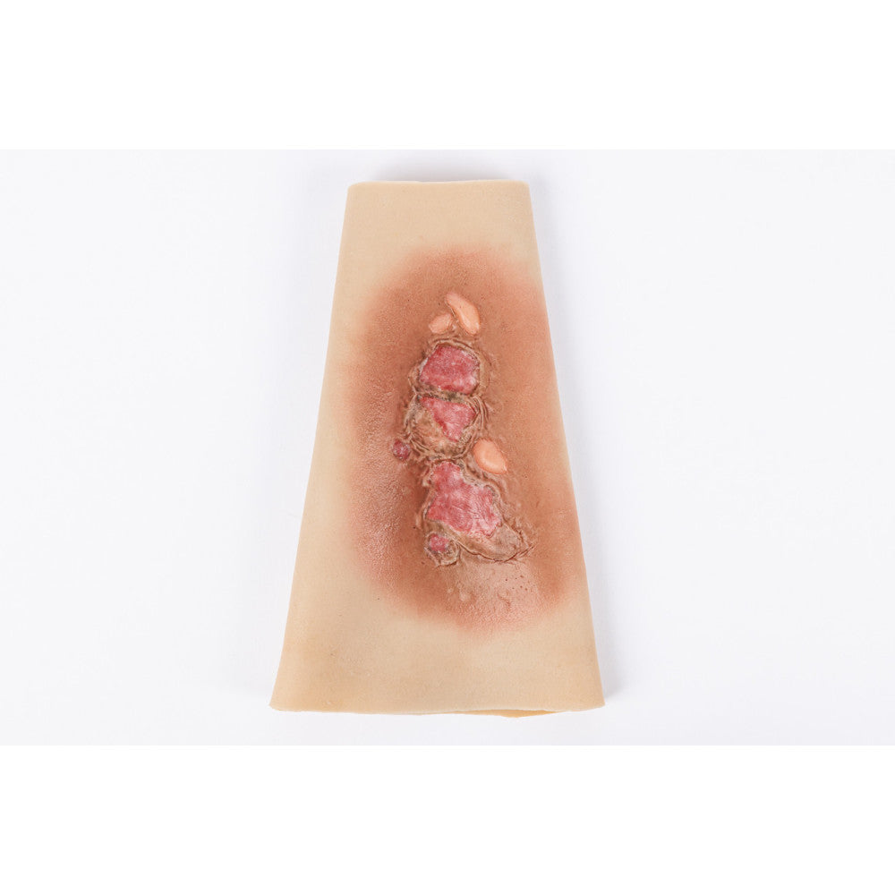TRAUMASIM Wearable Small Burn - Forearm – promedsupplies.com.au